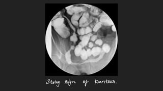 Inflammatory bowel disease - clinical features, diagnosis and ...