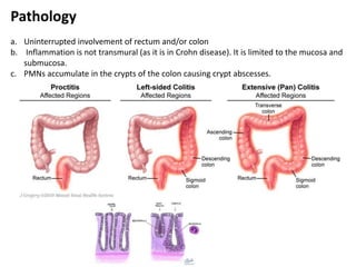 Inflammatory Bowel Disease.pptx