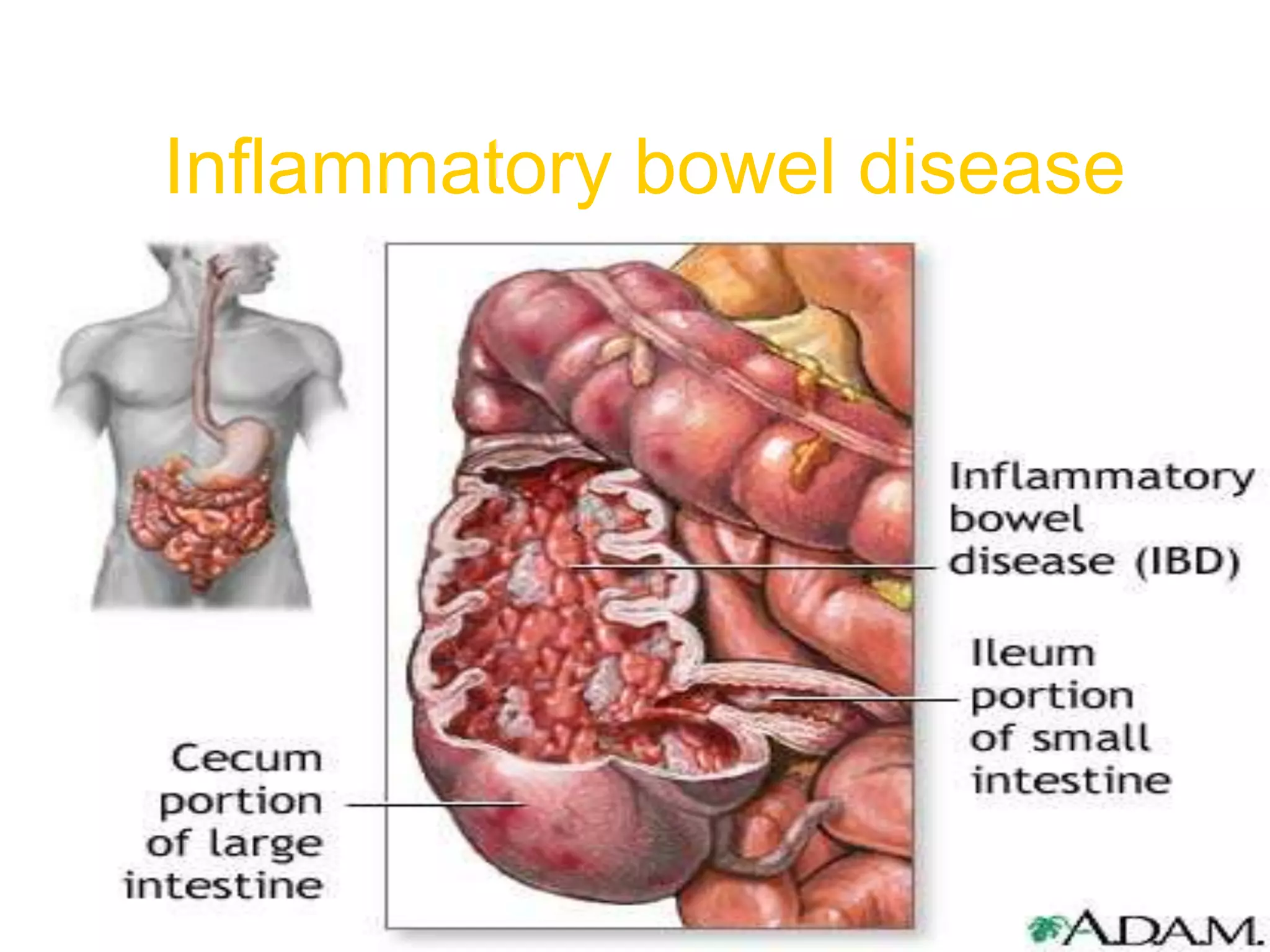 Inflammatory_Bowel_disease.ppt