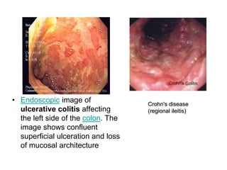Inflammatory_Bowel_disease.ppt
