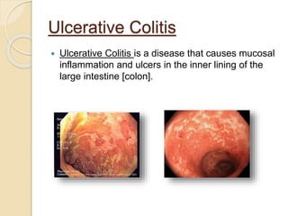 Pathophysiology of INFLAMMATORY BOWEL DISEASE | PPTX