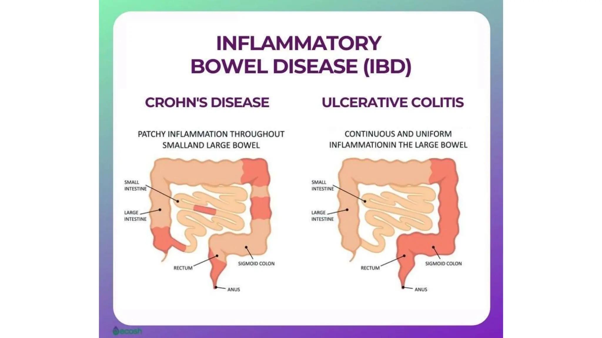 INFLAMMATORY BOWEL DISEASE-UC,CD DRUGS.pptx