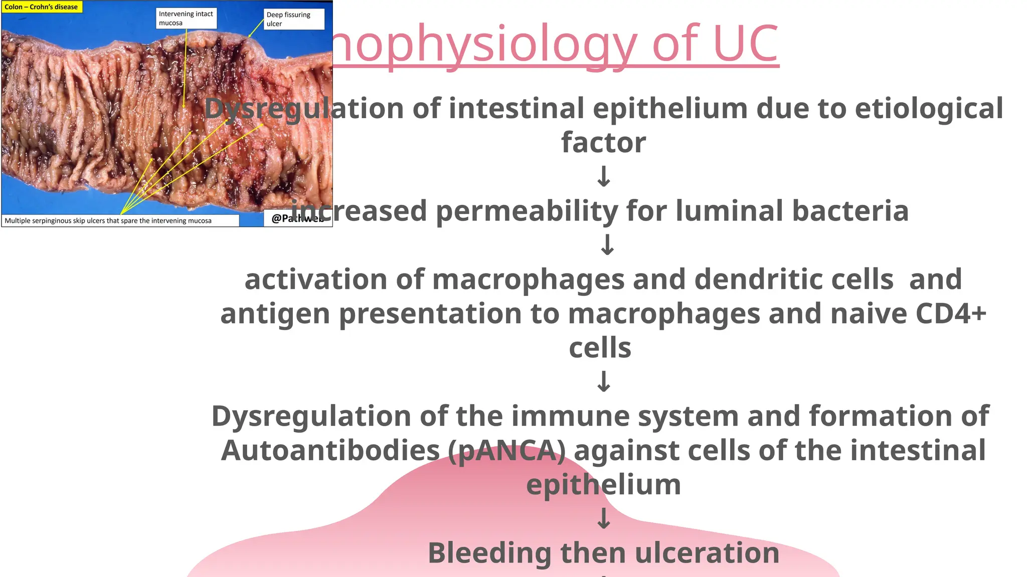 Inflammatory Bowel Disease (Crohn's and ulcerative colitis).pptx