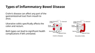 Inflammatory Bowel Disease.pptx……………………. | PPTX