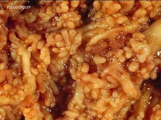 Inflammatory bowel disease by Dr. Garima Agarwal | PPTX