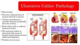 Inflammatory bowel disease- Lower gi hemorrhage | PPT
