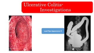 Inflammatory bowel disease- Lower gi hemorrhage | PPT