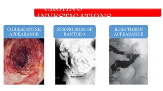 Inflammatory bowel disease- Lower gi hemorrhage | PPTX