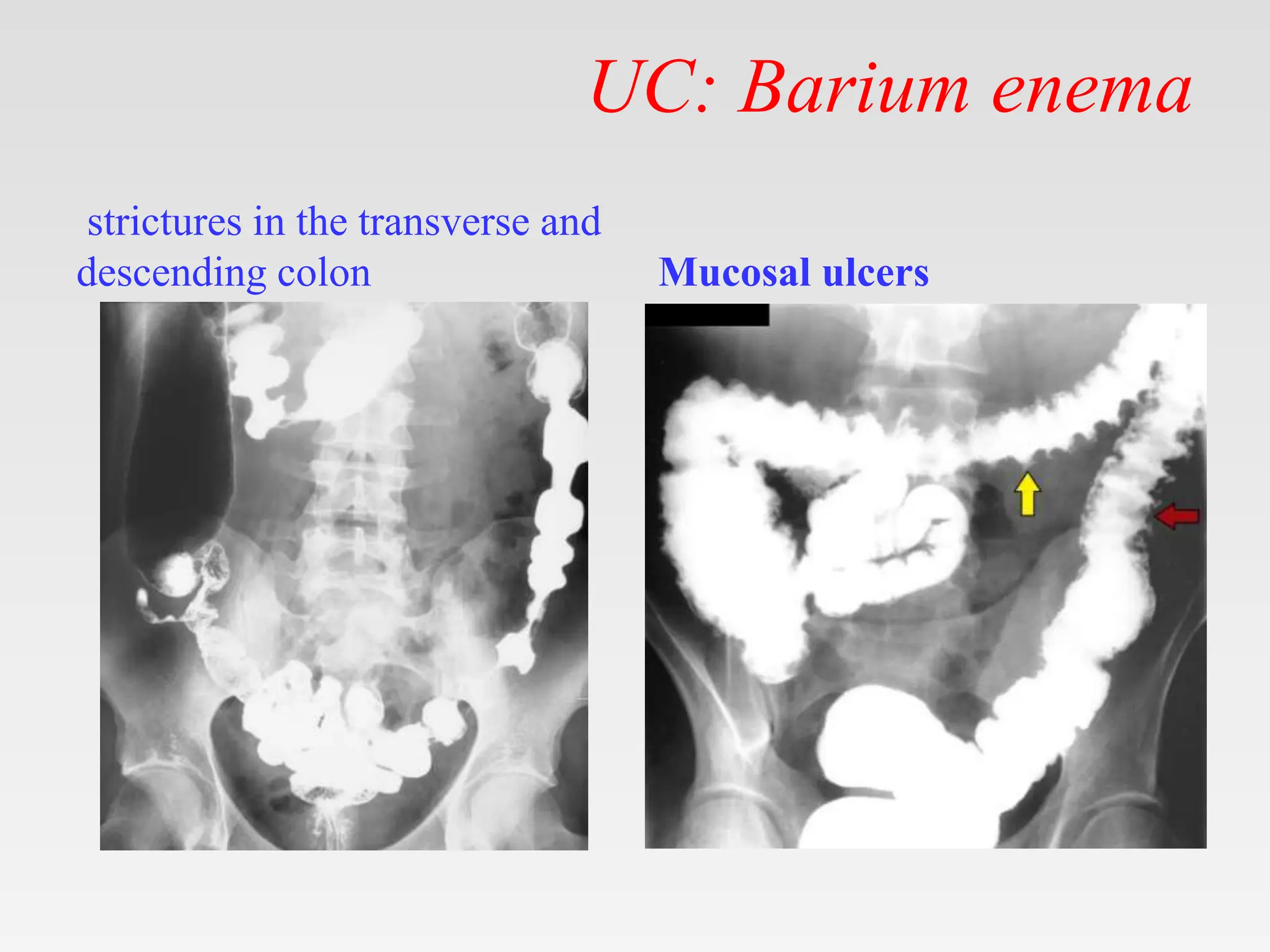 Inflammatory bowel disease clinical revised.pptx