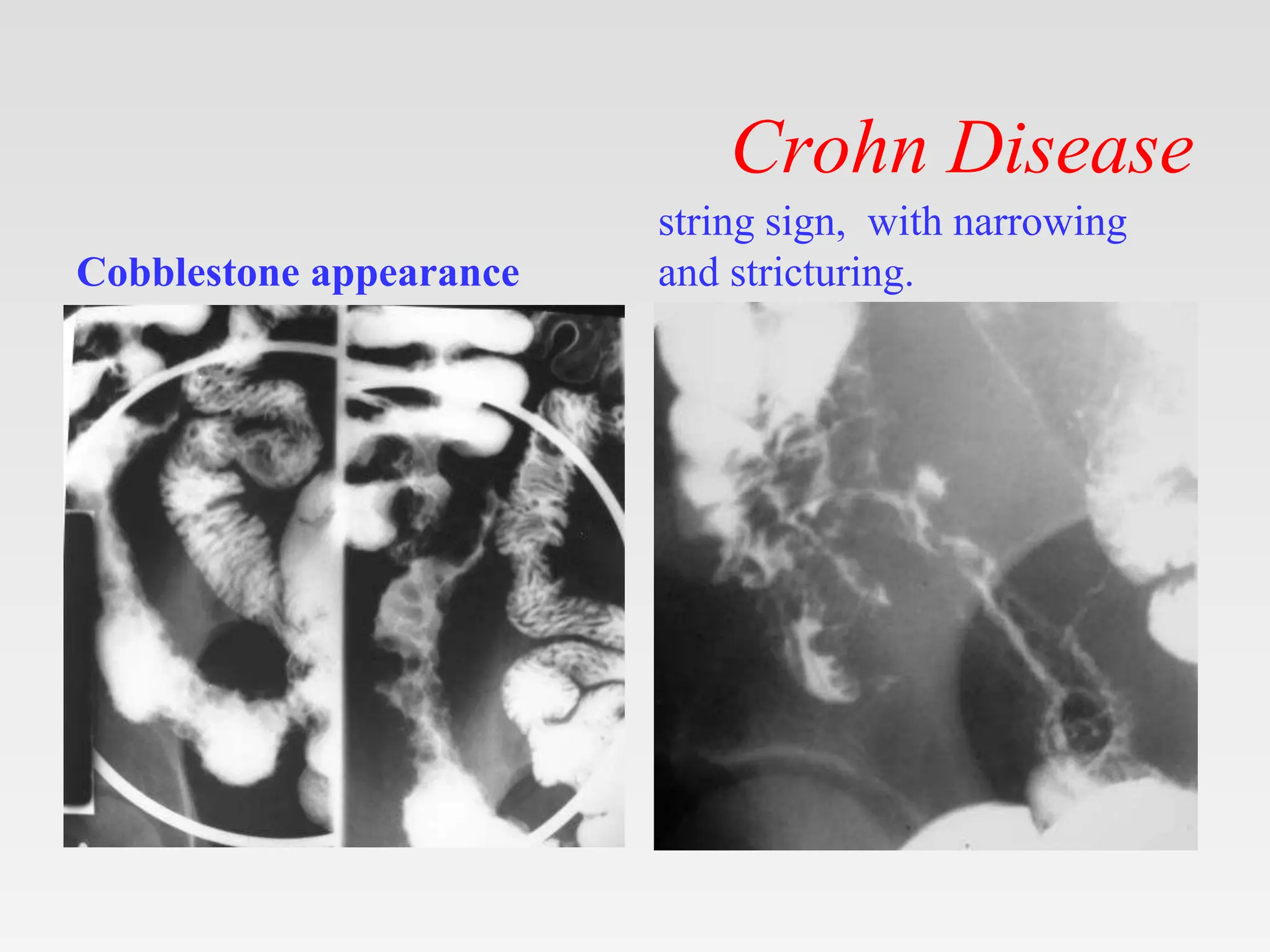 Inflammatory bowel disease clinical revised.pptx