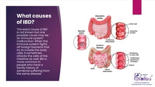 Inflammatory Bowel Disease (IBD) | Dr. Vedant Karvir | PPT