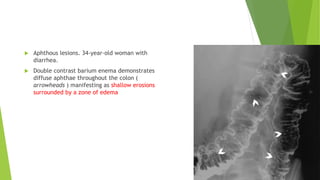 Inflammatory bowel disease imaging | PPTX