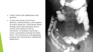 Inflammatory bowel disease imaging | PPTX