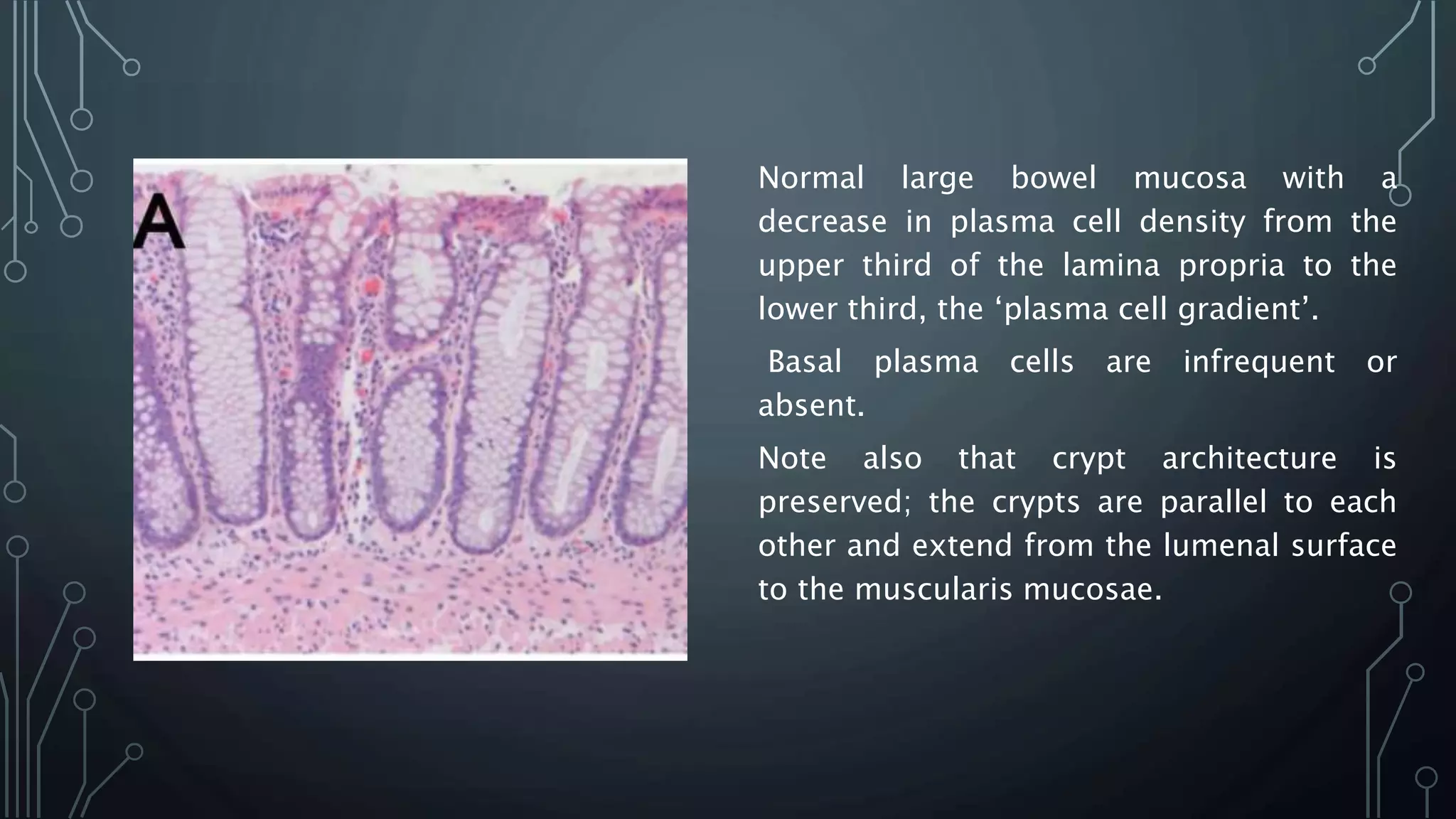 INFLAMMATORY BOWEL DISEASE PATHOLOGY.pptx