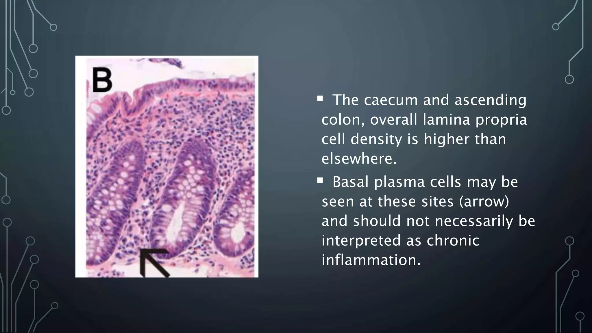 INFLAMMATORY BOWEL DISEASE PATHOLOGY.pptx