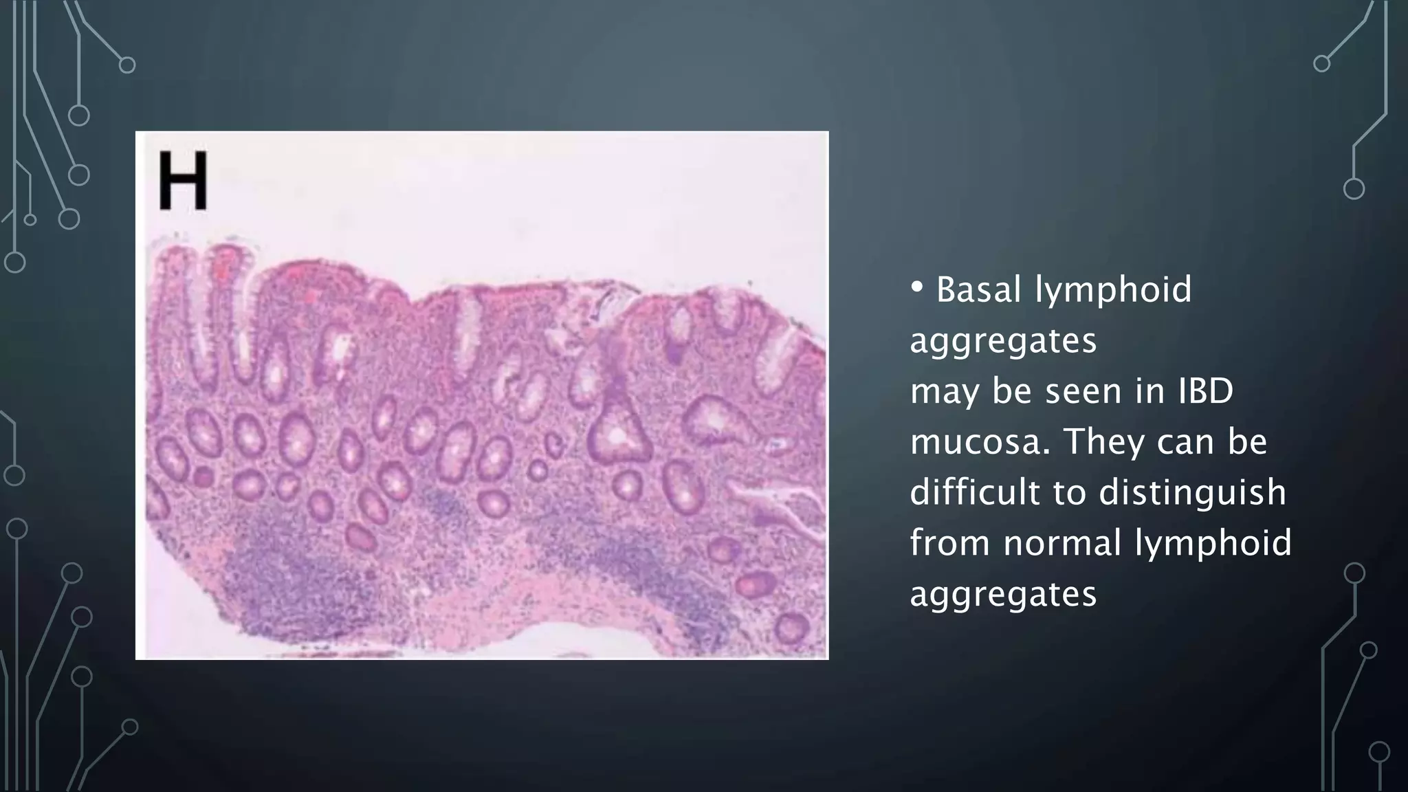 INFLAMMATORY BOWEL DISEASE PATHOLOGY.pptx