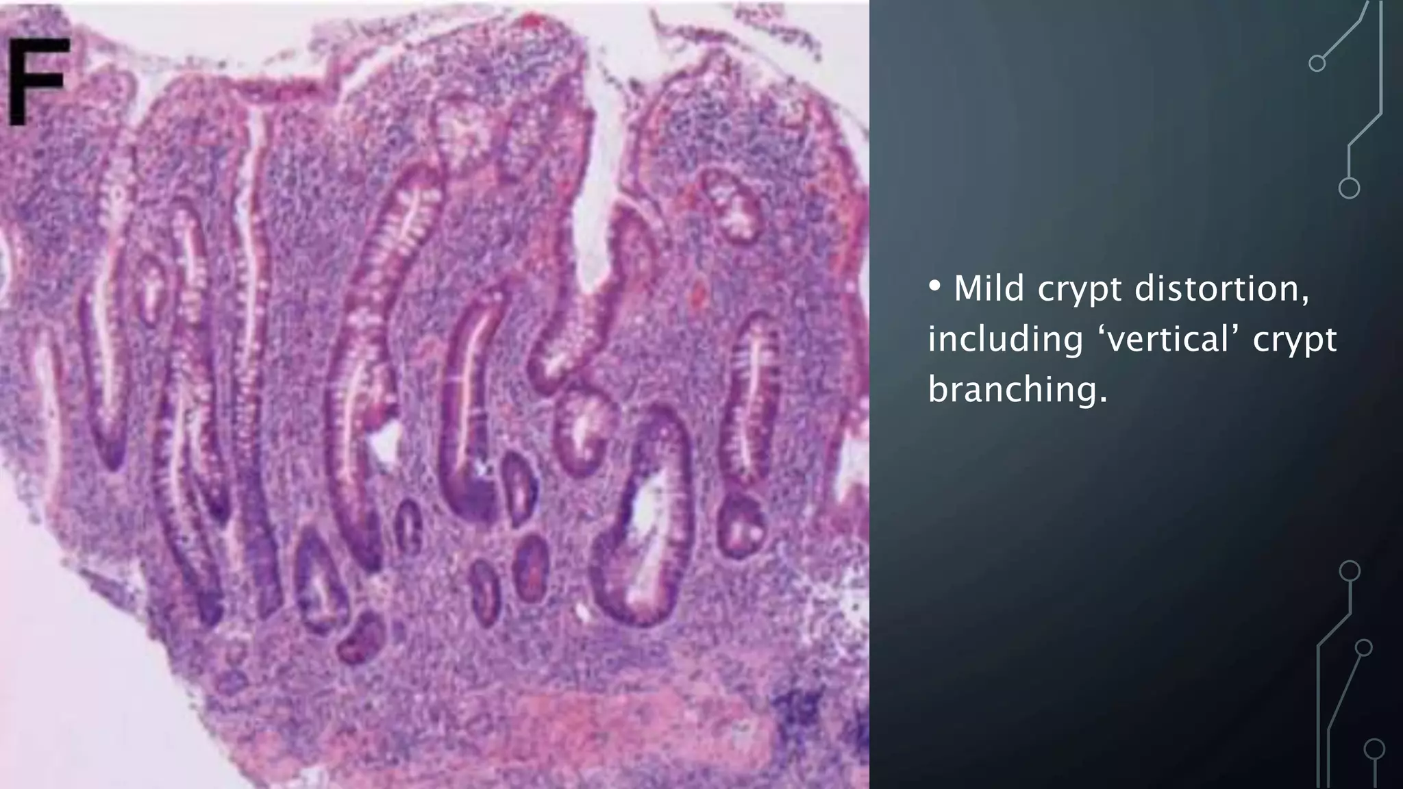 INFLAMMATORY BOWEL DISEASE PATHOLOGY.pptx