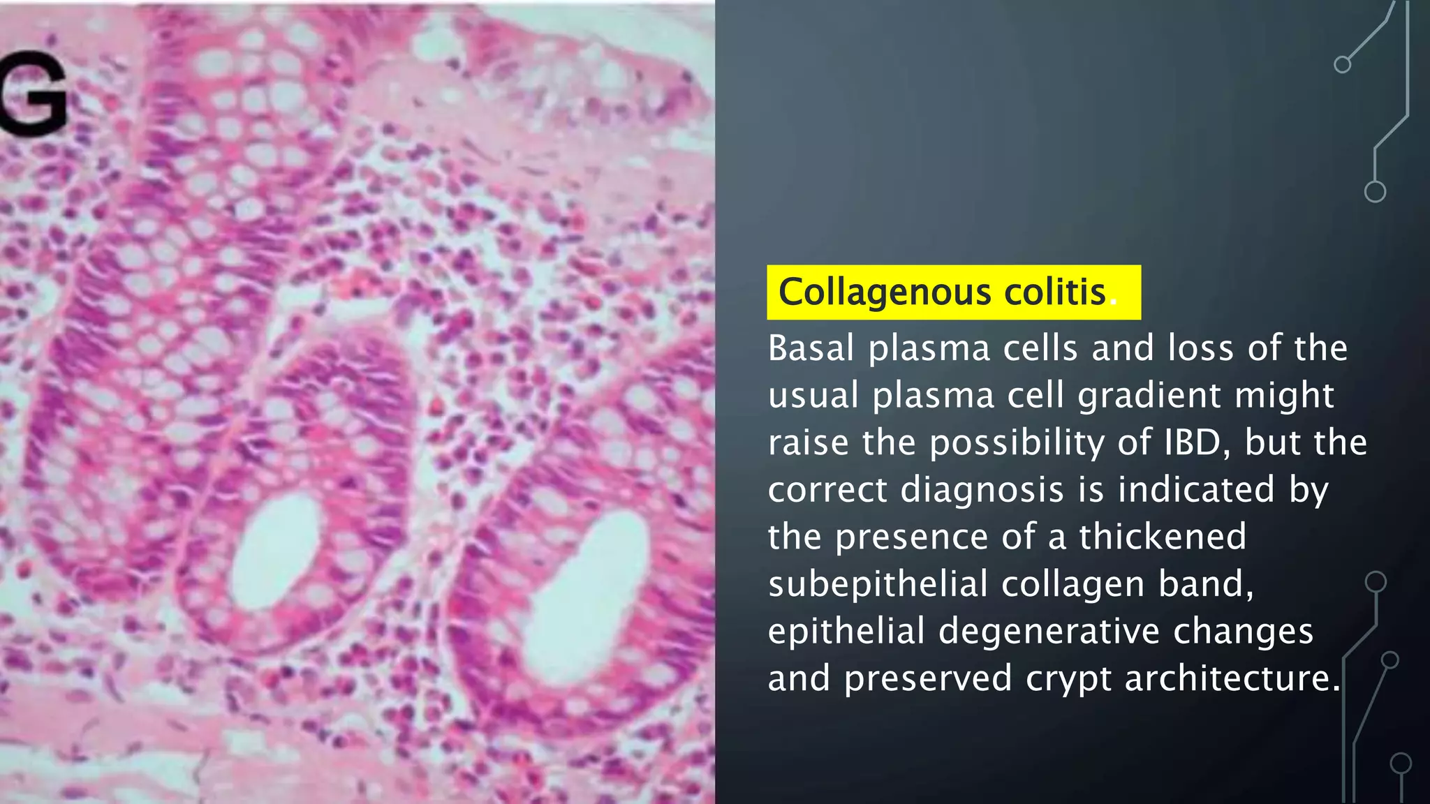 INFLAMMATORY BOWEL DISEASE PATHOLOGY.pptx
