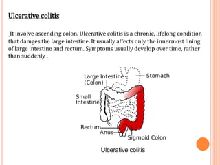 Inflammatory bowel disease ppt..pptx