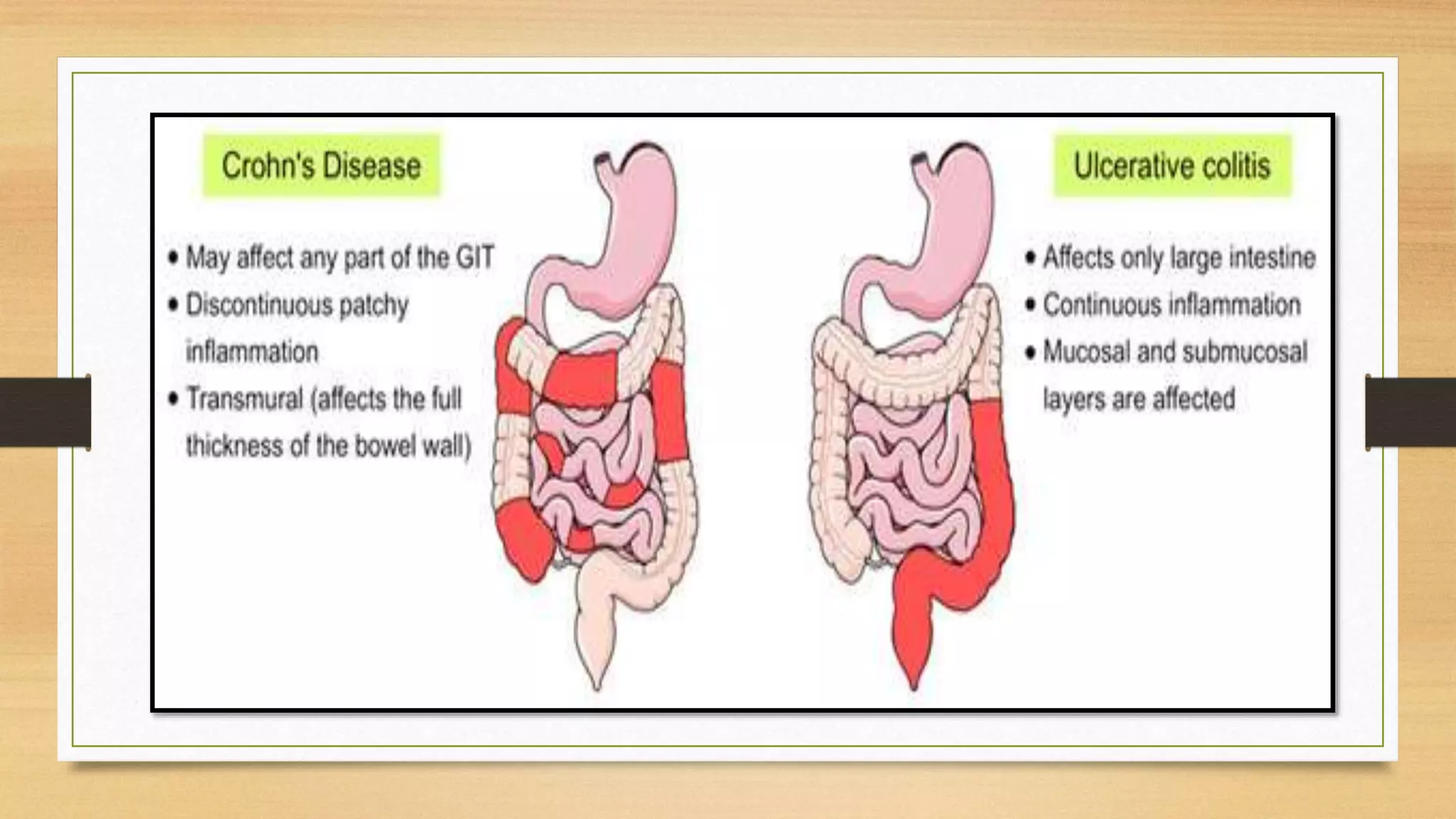 Inflammatory bowel diseases | PPT