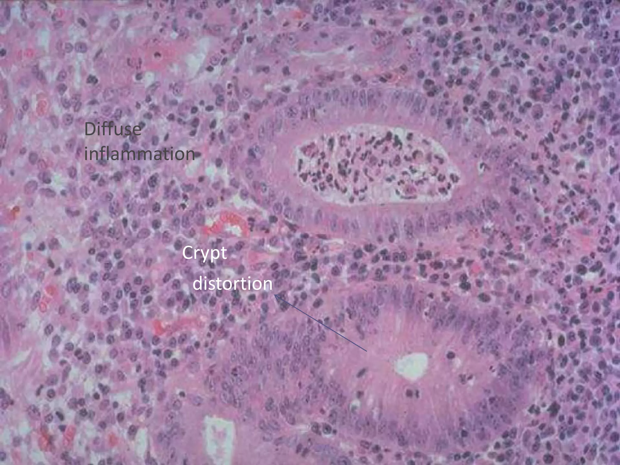 Inflammatory bowel diseases | PPTX