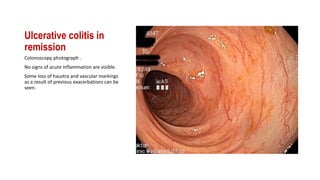 Inflammatory Bowel Diseases.........pptx
