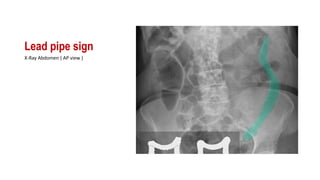 Inflammatory Bowel Diseases.........pptx