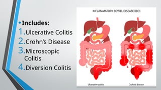 INFLAMMATORY BOWEL DISEASE Crohns and ulcerative coliits | PPTX