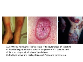 Inflammatory Bowel Diseases (IBD) | PPT