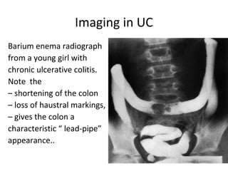 Inflammatory Bowel Diseases (IBD) | PPT