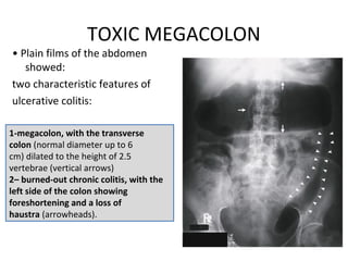 Inflammatory Bowel Diseases (IBD) | PPT