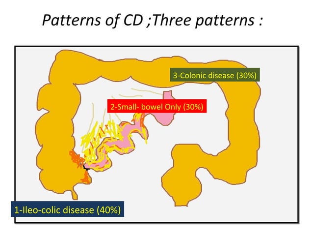 Inflammatory Bowel Diseases (IBD) | PPT