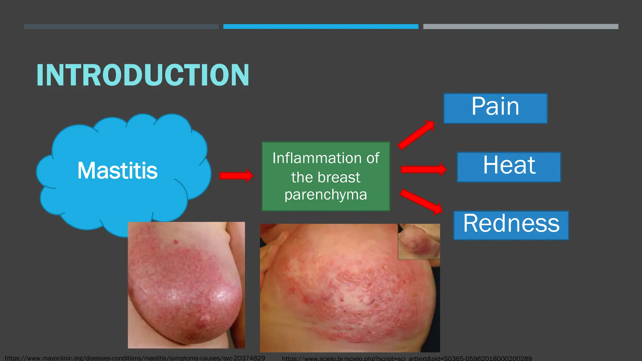 inflammatory breast disease (Handout).pdf | Blood Disorders | Diseases ...