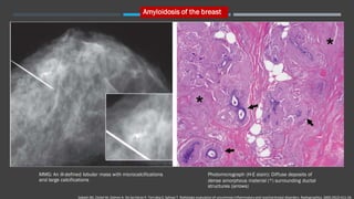 inflammatory breast disease (Handout).pdf