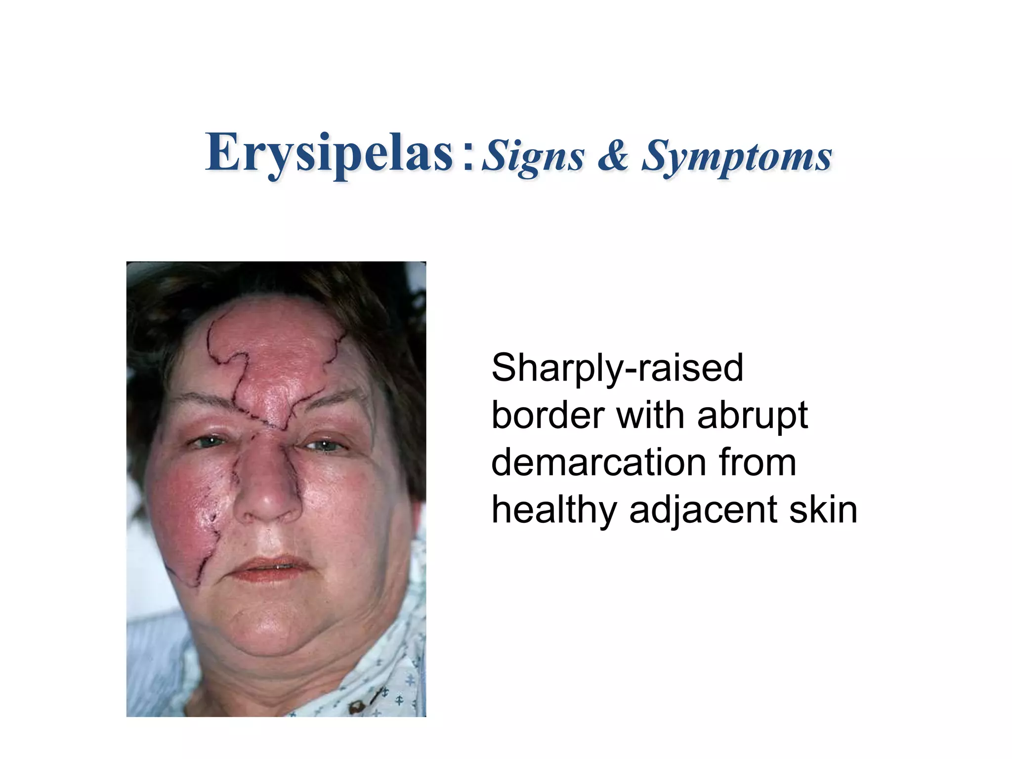 Inflammatory conditions of skin | PPTX