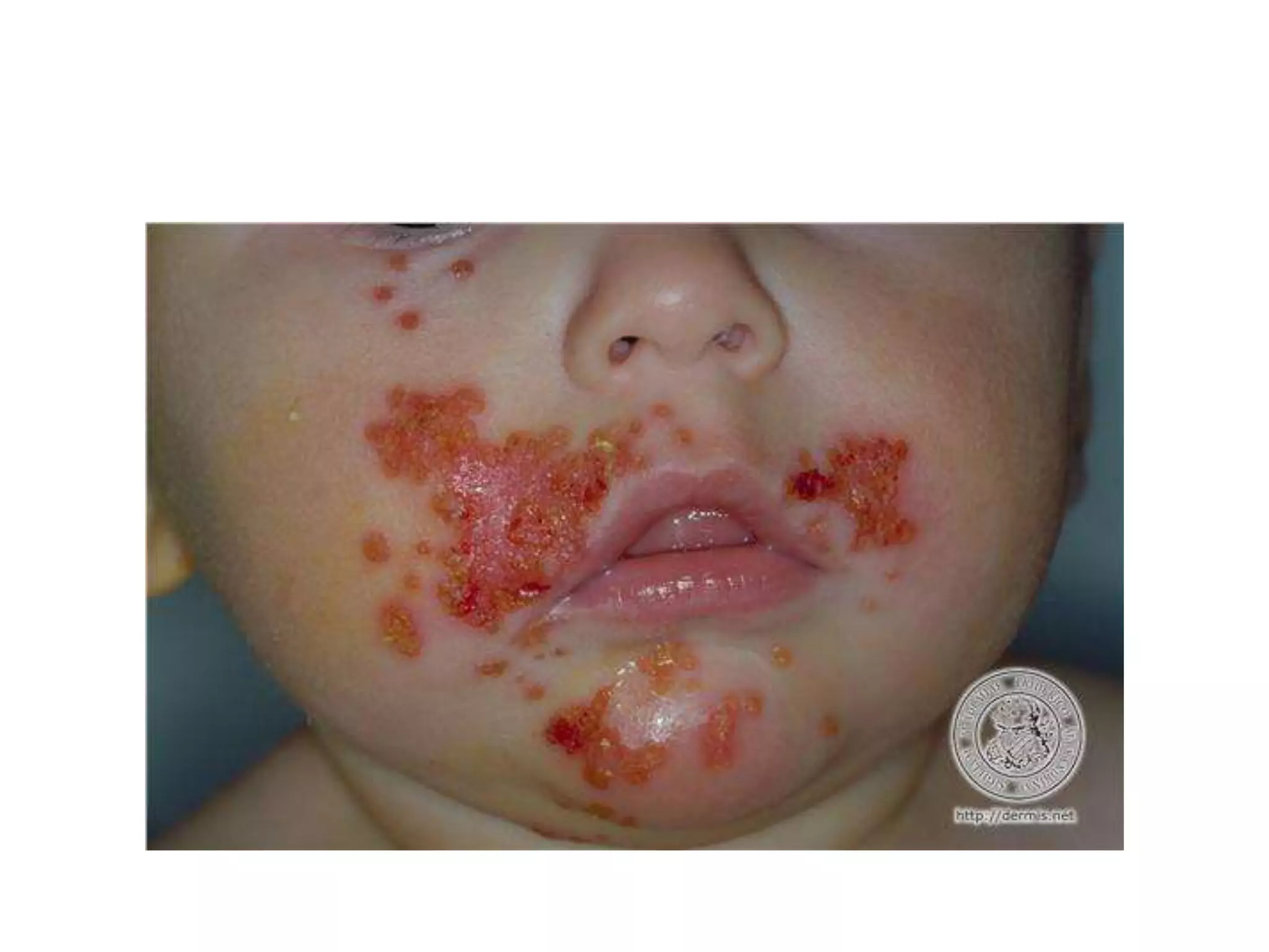 Inflammatory conditions of skin | PPTX