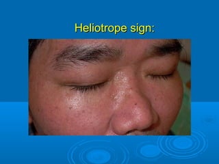 Inflammatory disease of muscle | PPT