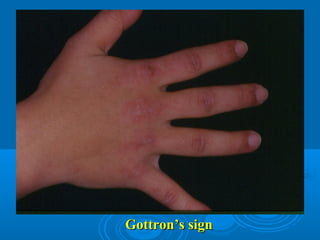 Inflammatory disease of muscle | PPT