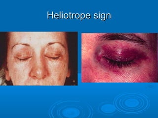 Inflammatory disease of muscle | PPT