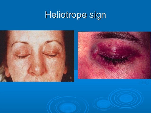 Inflammatory disease of muscle