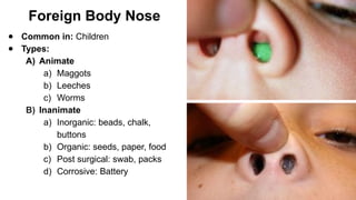 INFLAMMATORY DISEASES OF NOSE (INCLUDING Atrophic rhinitis, Allergic ...
