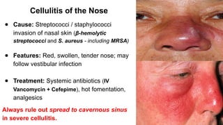 INFLAMMATORY DISEASES OF NOSE (INCLUDING Atrophic rhinitis, Allergic ...