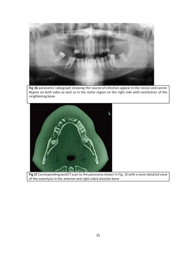 Inflammatory lesions of the jaws classification and imaging detailes | DOCX