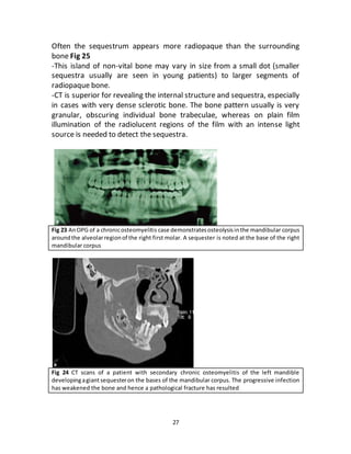 Inflammatory lesions of the jaws classification and imaging detailes | DOCX