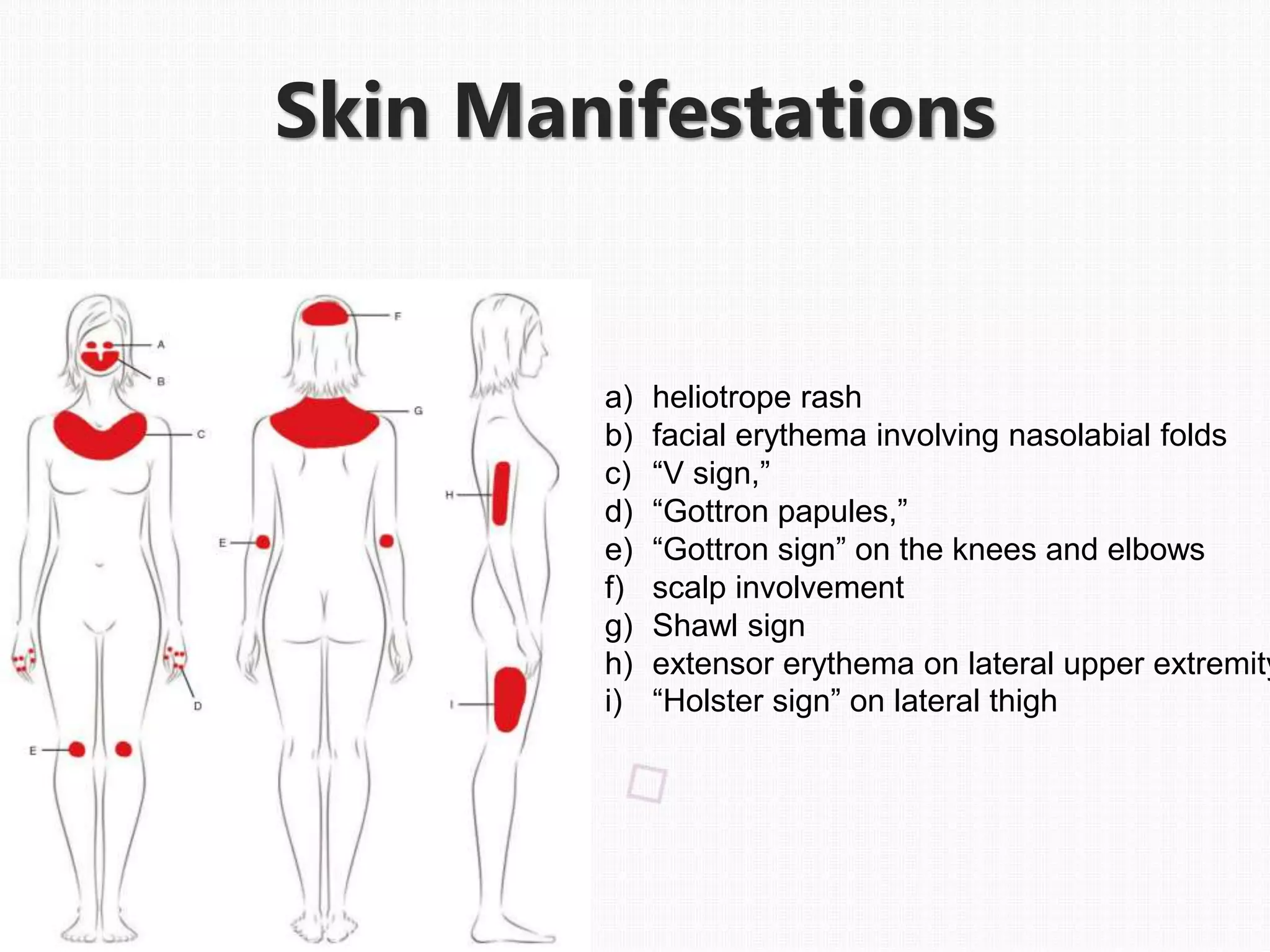 Inflammatory myopathies | PPTX