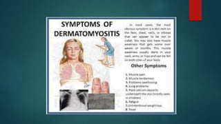 Inflammatory myopathies -DERMATOMYOSITIS | PPTX