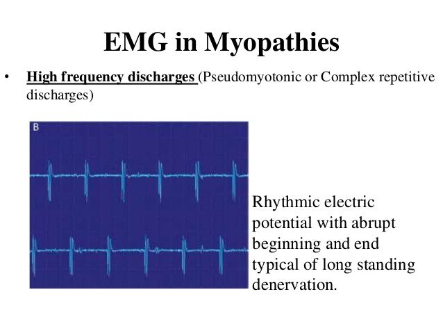 Inflammatory Myopathies