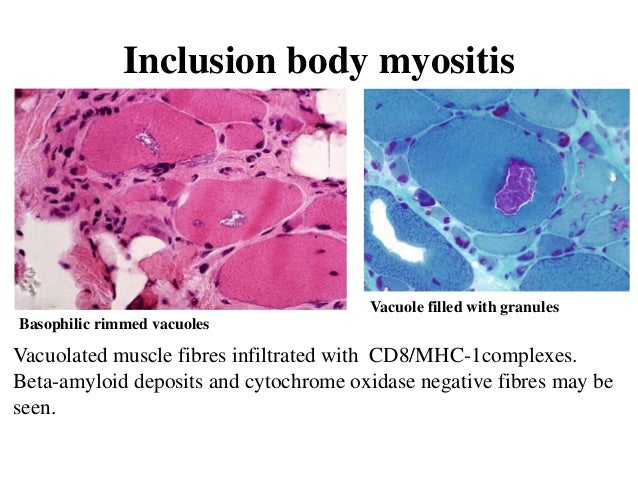 Inflammatory Myopathies
