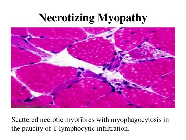 Inflammatory Myopathies