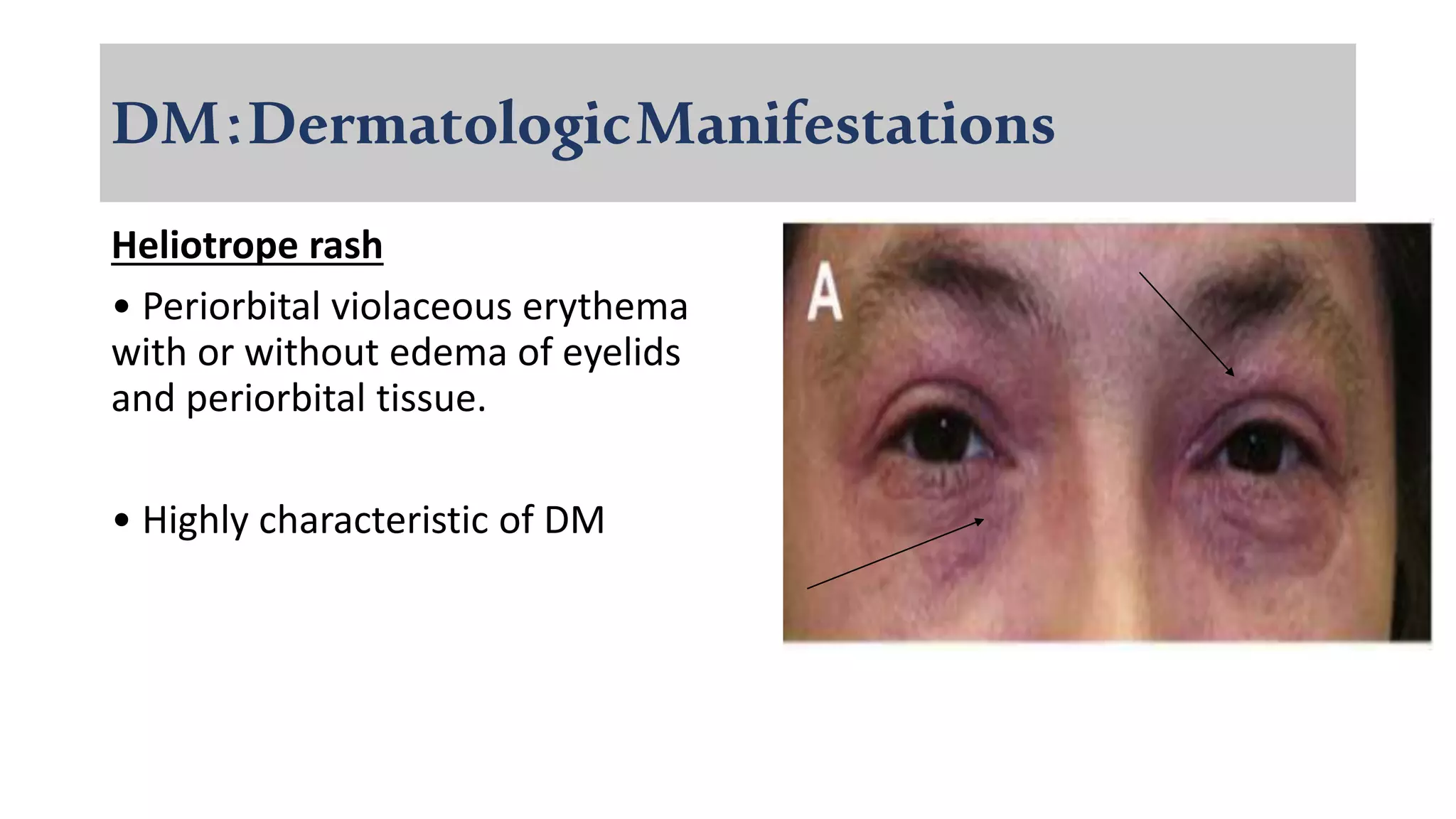 Inflammatory myositis | PPTX